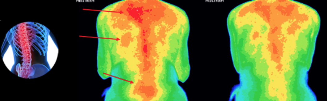 Back Pain Results - ENAR Device & ENAR Therapy