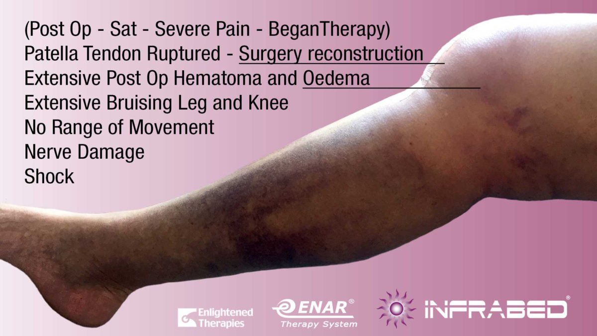 PK Post-Op-Knee Surgery Recovery Story - ENAR Device & ENAR Therapy